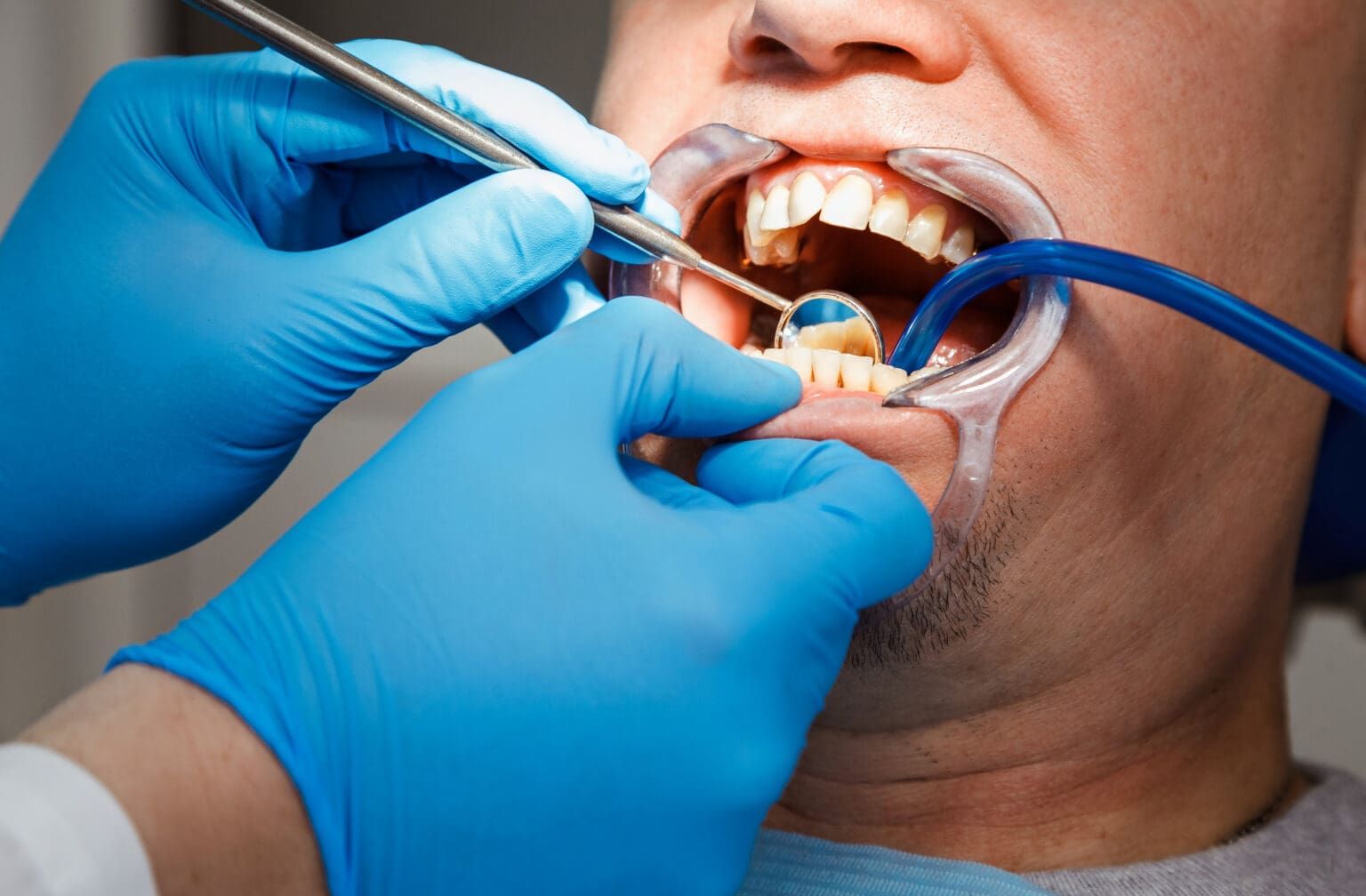 Everything You Need to Know About Tooth-Colored Fillings - Dr. Monica ...