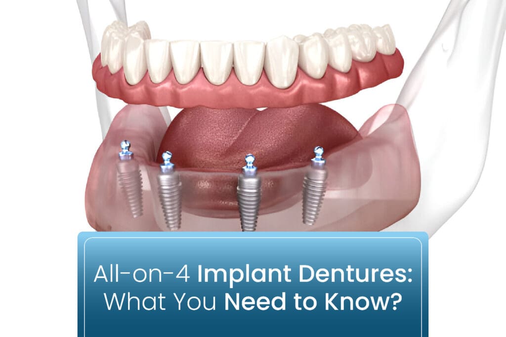 All-on-4 Implants Guide: Key Facts You Should Know